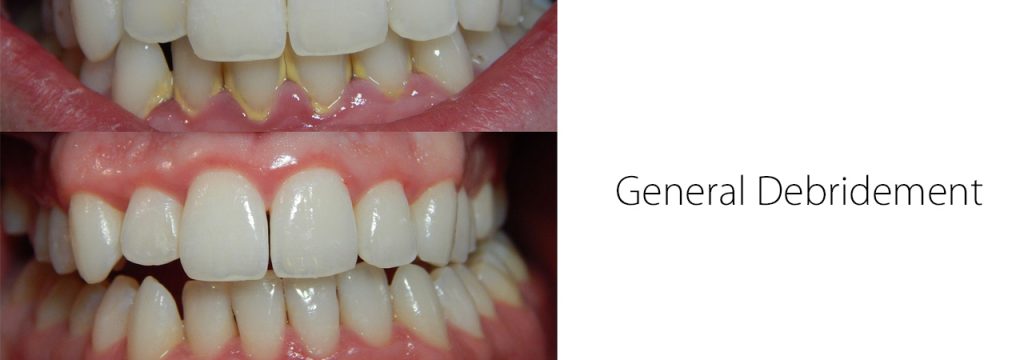 General Debridement - Kians Dental Studio